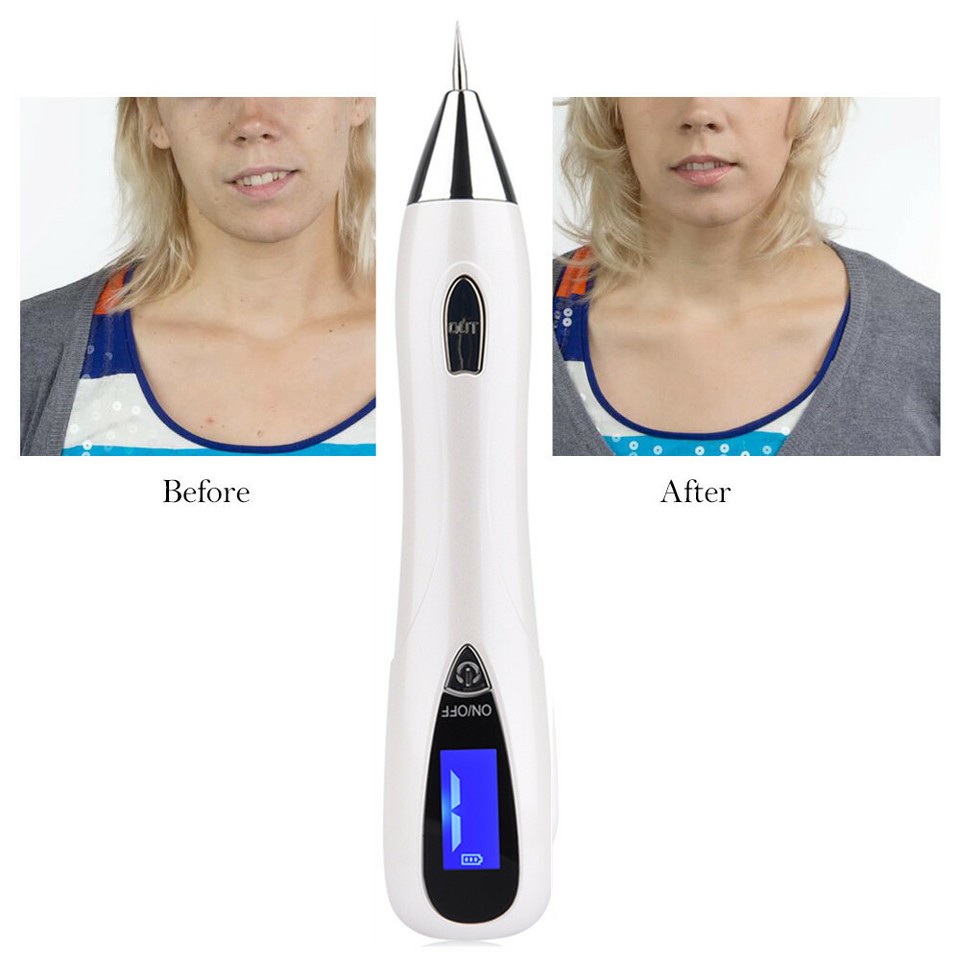 Electric Laser Skin Tag Freckle Wart Dot Mole Remove Pen DarkSpot ...