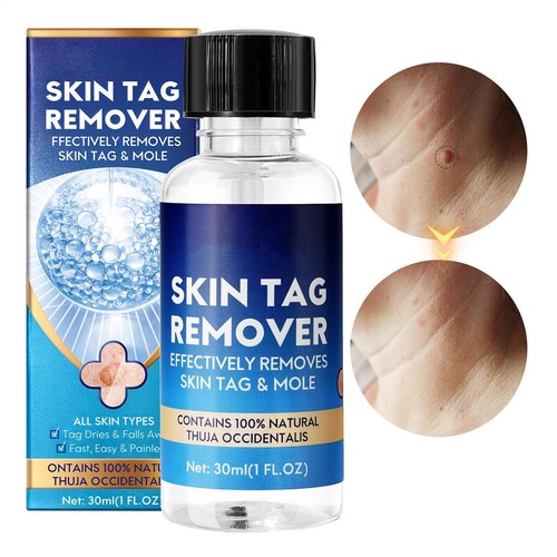 30ml Wart Remover Liquid Painlessly Skin Tag mole Remover | eBay UK