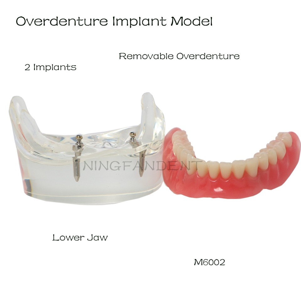 Dental Implant Modle,Demo RPD/ Overdenture/All-On-4 Treatment ...