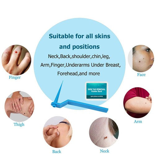 Micro Skin Tag Remover tool Kit Painless Wart Acne Skin Tags Removal ...