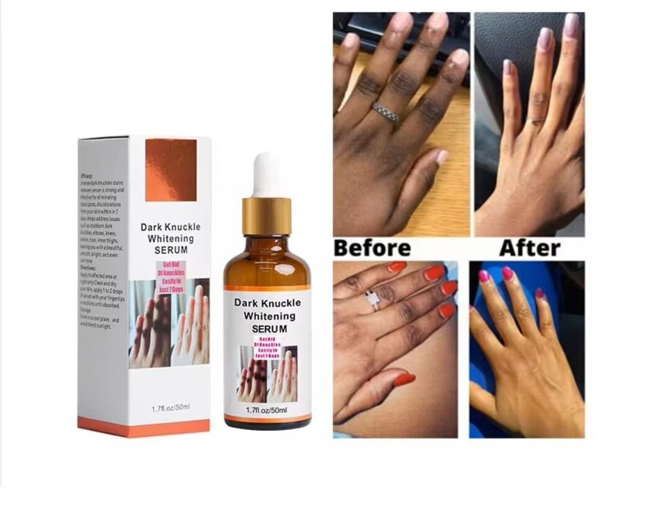 Strong Whitening Dark Skin Knuckles Feets Knees Elbows Armpit inner ...