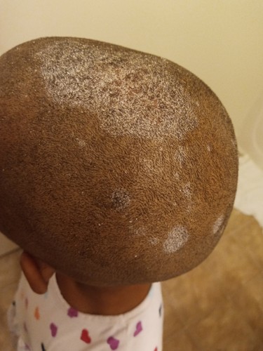 Ringworm Cream Fast Acting 100 Natural Plant Based Safer Than OTC ...