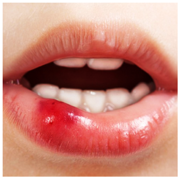 2x ORREPASTE Mouth Ulcer Gel Treatment 5g Relief Oral Inflammatory Free ...