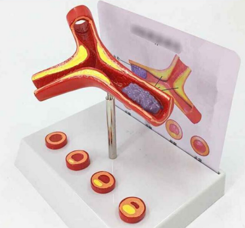 New Anatomical Vascular Atherosclerosis Pathology Medical Show Model | eBay