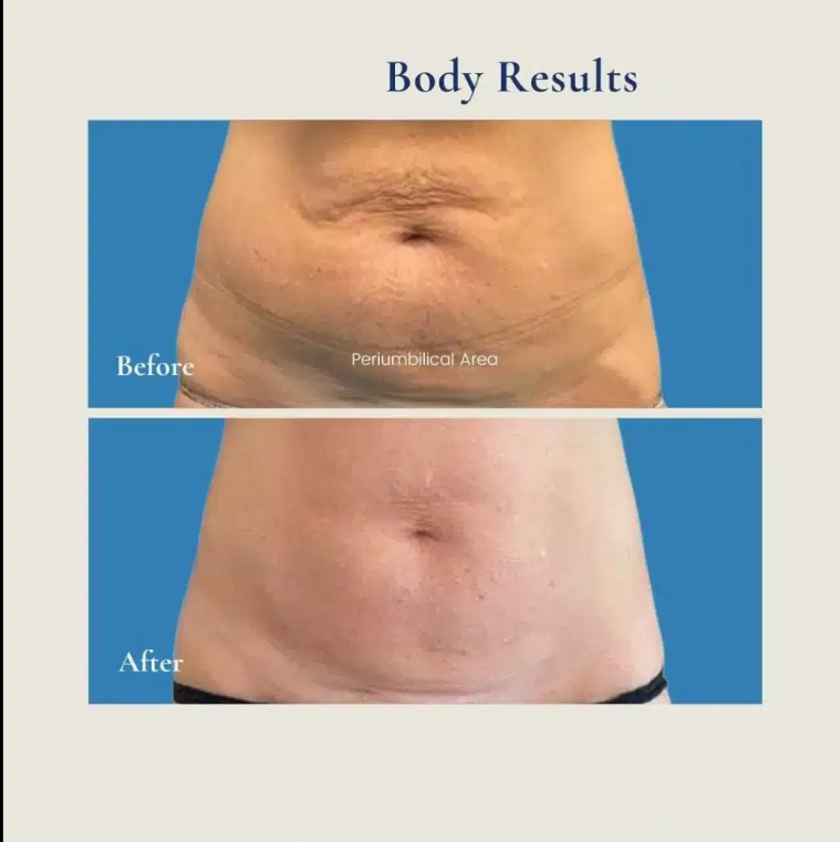 2025 Endolift Laser Body Shaping Machine for Fat Ablation and Skin ...