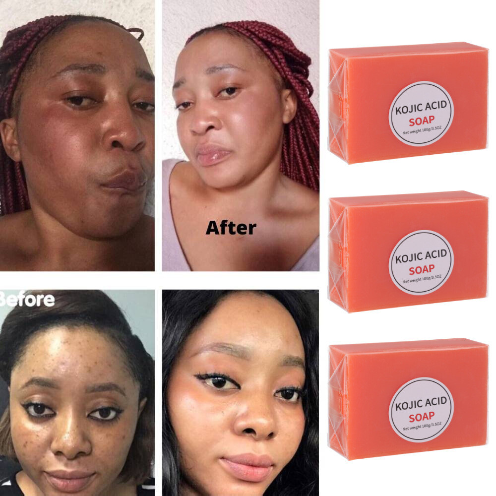 Kojic Acid Soap Before After Kojic Acid Soap – Unamiskincare