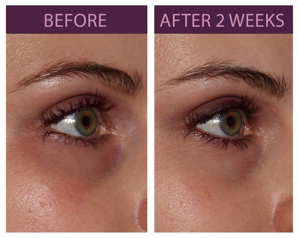 Under EYE CREAM w/Hyaluronic Acid, Matrixyl, Stem Cells for Dark ...