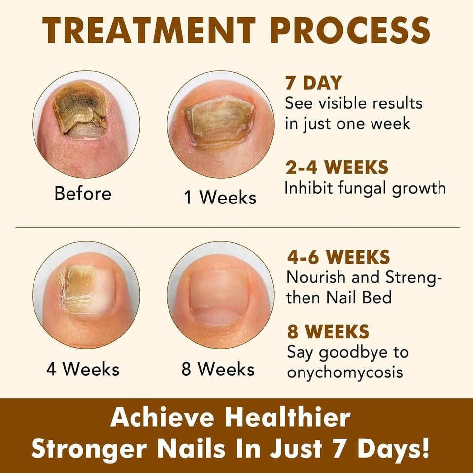 Fungal Nail Treatment Extra Strong Ginger Nail Fungus for Toenails ...