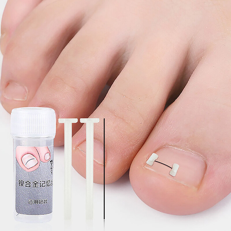 Universal Croppable Ingrown Toenail Care Straightening Clip Elastic ...