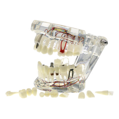 Dental Oral Typodont Model Implant Pathological Removable Teach Visible ...