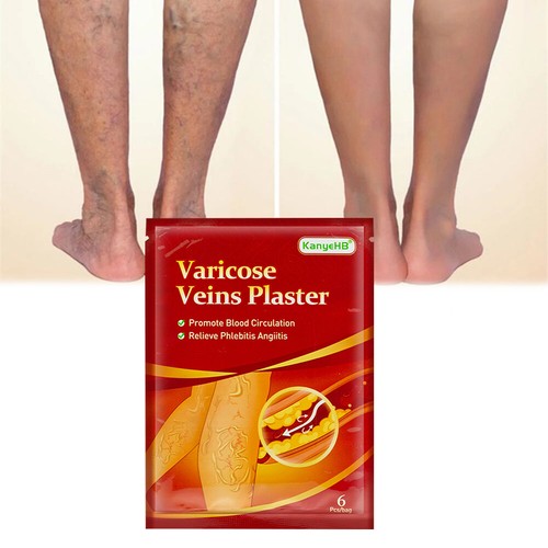 6/12/24pcs Varicose Veins Plaster Vasculitis Phlebitis Spider Leg ...