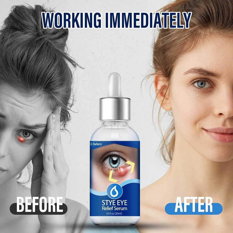 Stye Eye Treatment,1 Fl.oz Natural Stye Eye Treatment Drops – Fast ...