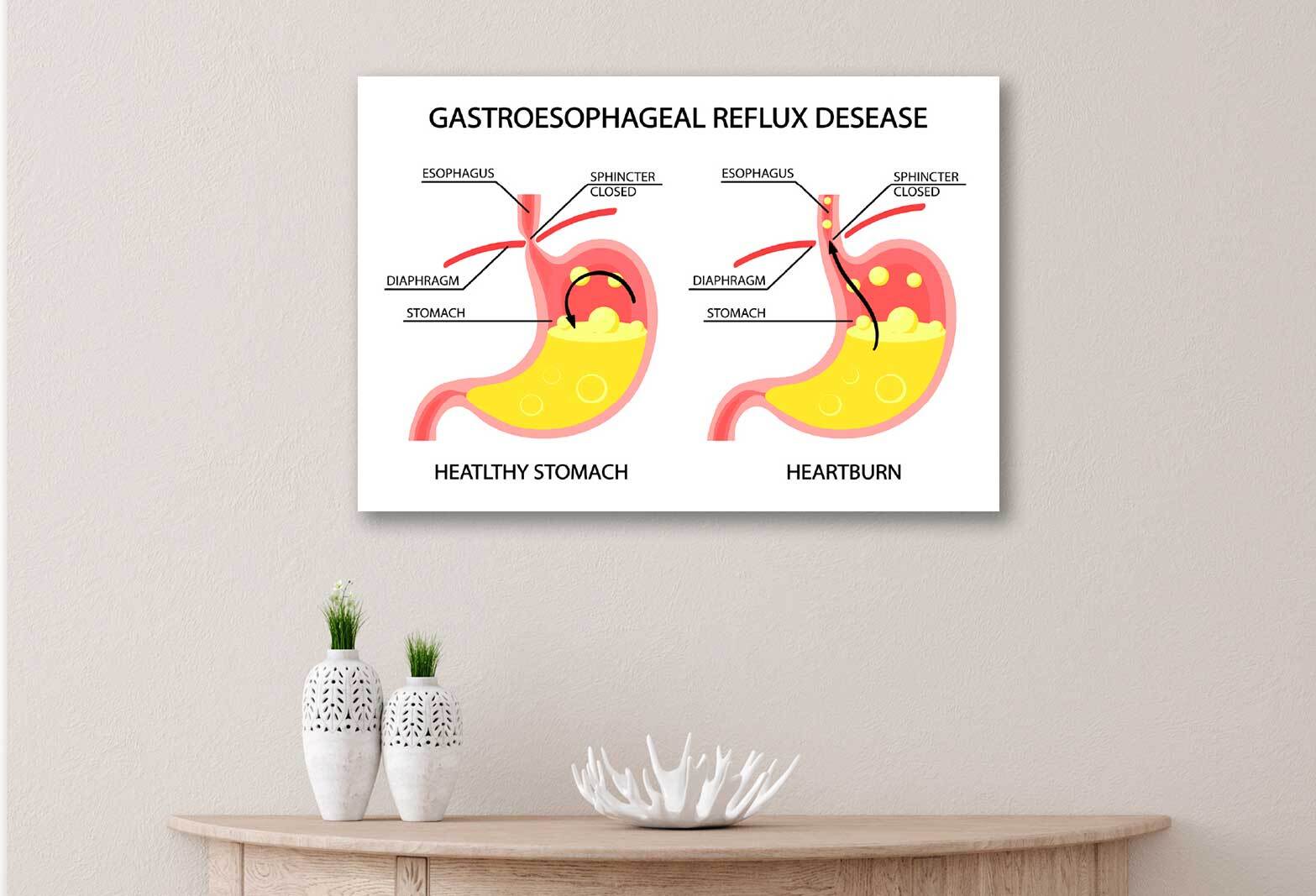 Gastroesophageal Reflux Disease Plastic Poster Ready to Hang | eBay ...