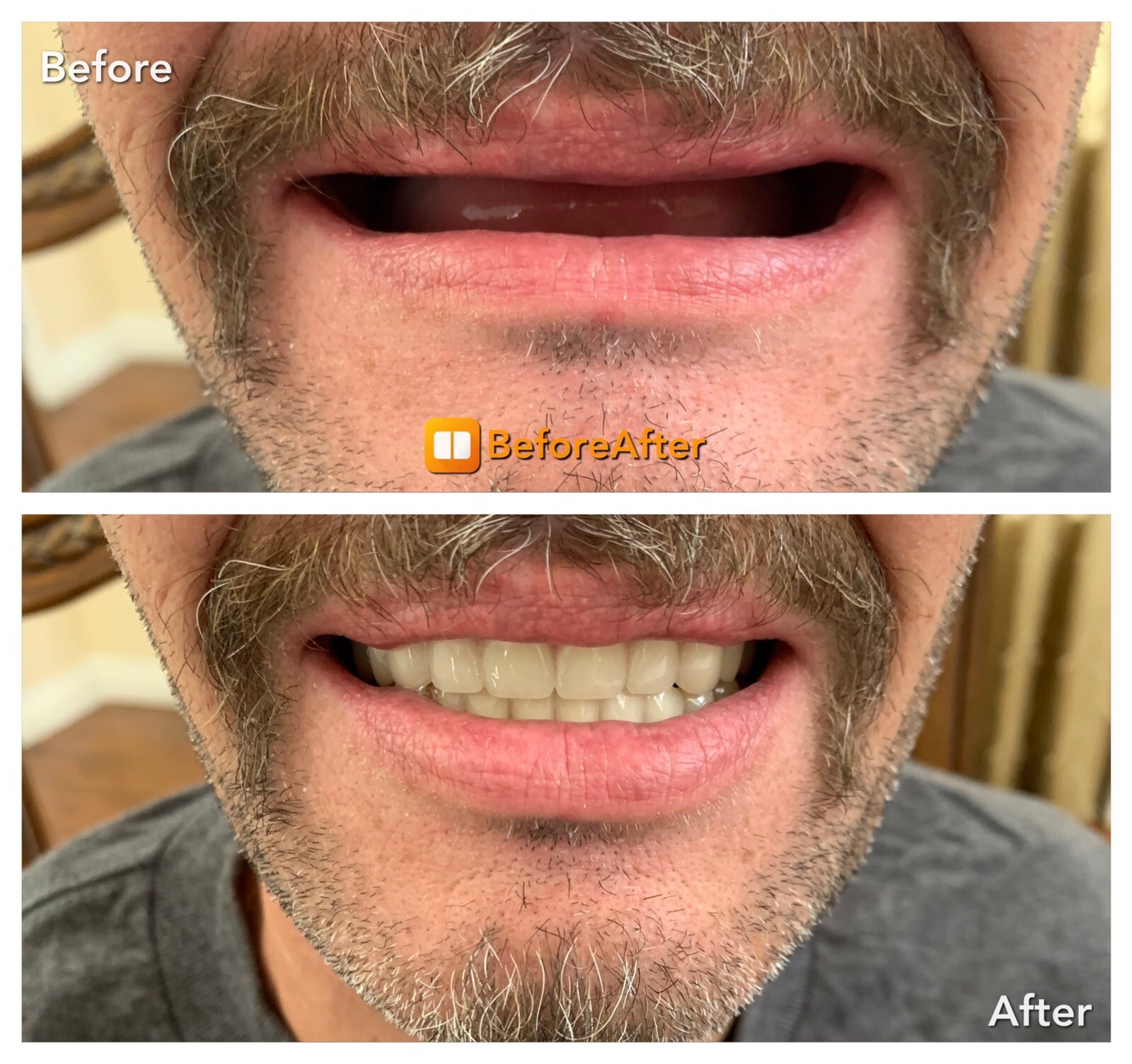 denture,partial,flipper,stayplate,nightguard,sportguard,retainer ...