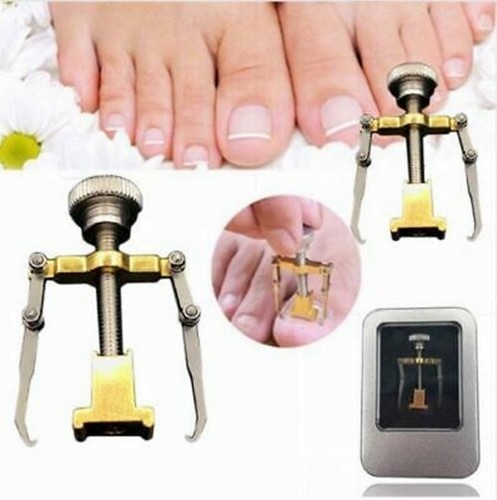 Eingewachsener Zehennagel Korrektur Nagel Fixer Fixieren Pediküre ...