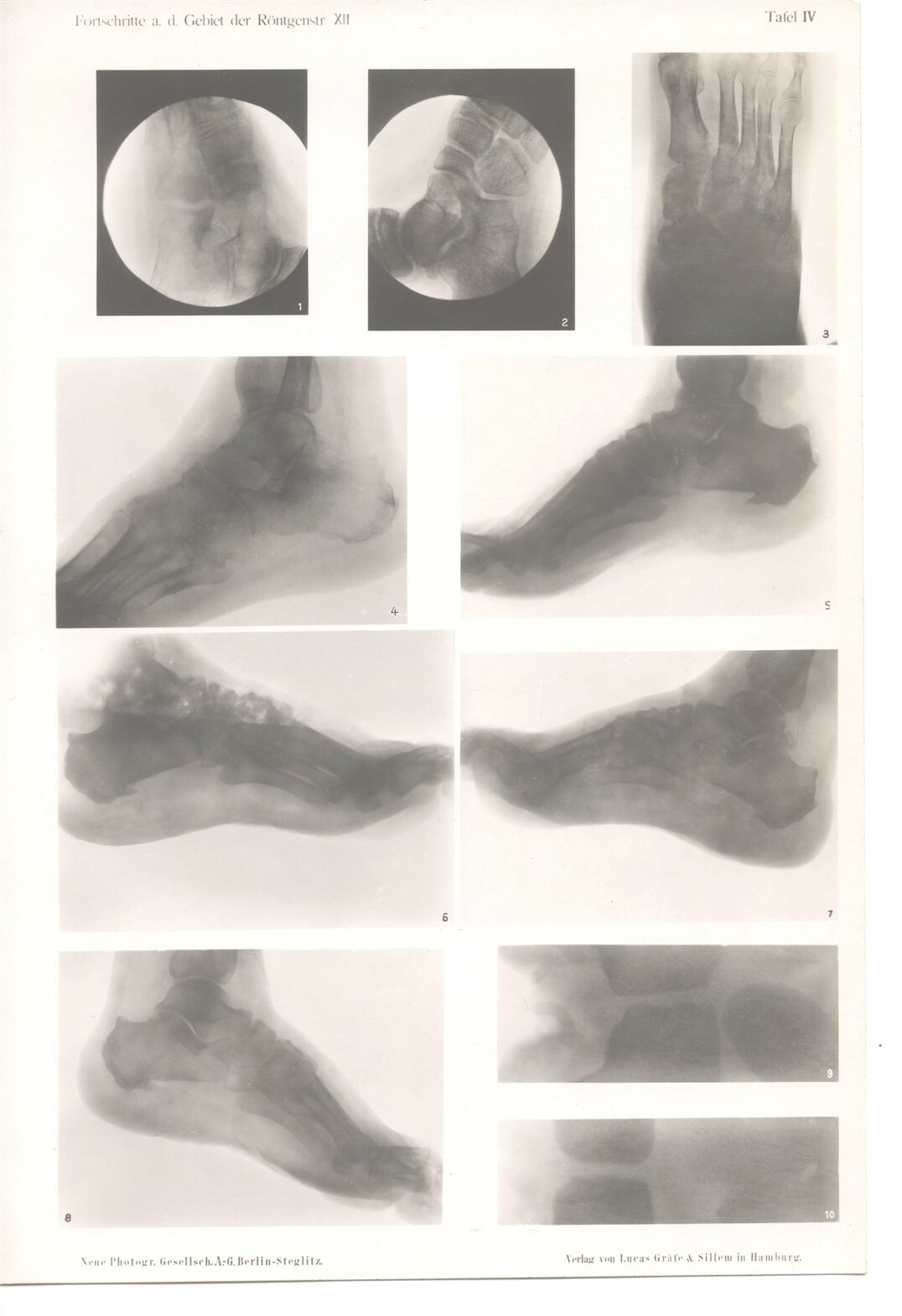 1908 ORIGINAL XRAY X-RAY PHOTOGRAPH HUMAN FOOT ANKLE TOES ODDITY ...
