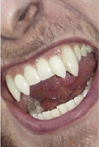 Werewolf Vampire Deluxe Fang Caps Halloween Wolf Custom Fit Fangs ...