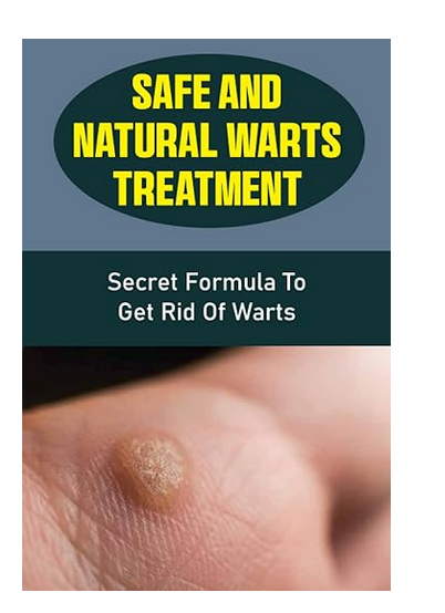 Safe And Natural Warts Treatment: Secret Formula To Get Rid Of Warts ...