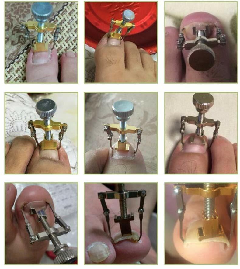 Eingewachsener Zehennagel Korrektur Nagel Fixer Fixieren Pediküre ...