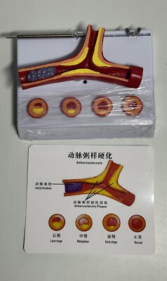 Human Atherosclerosis Cardiovascular Model Blood Vessel Thrombosis ...