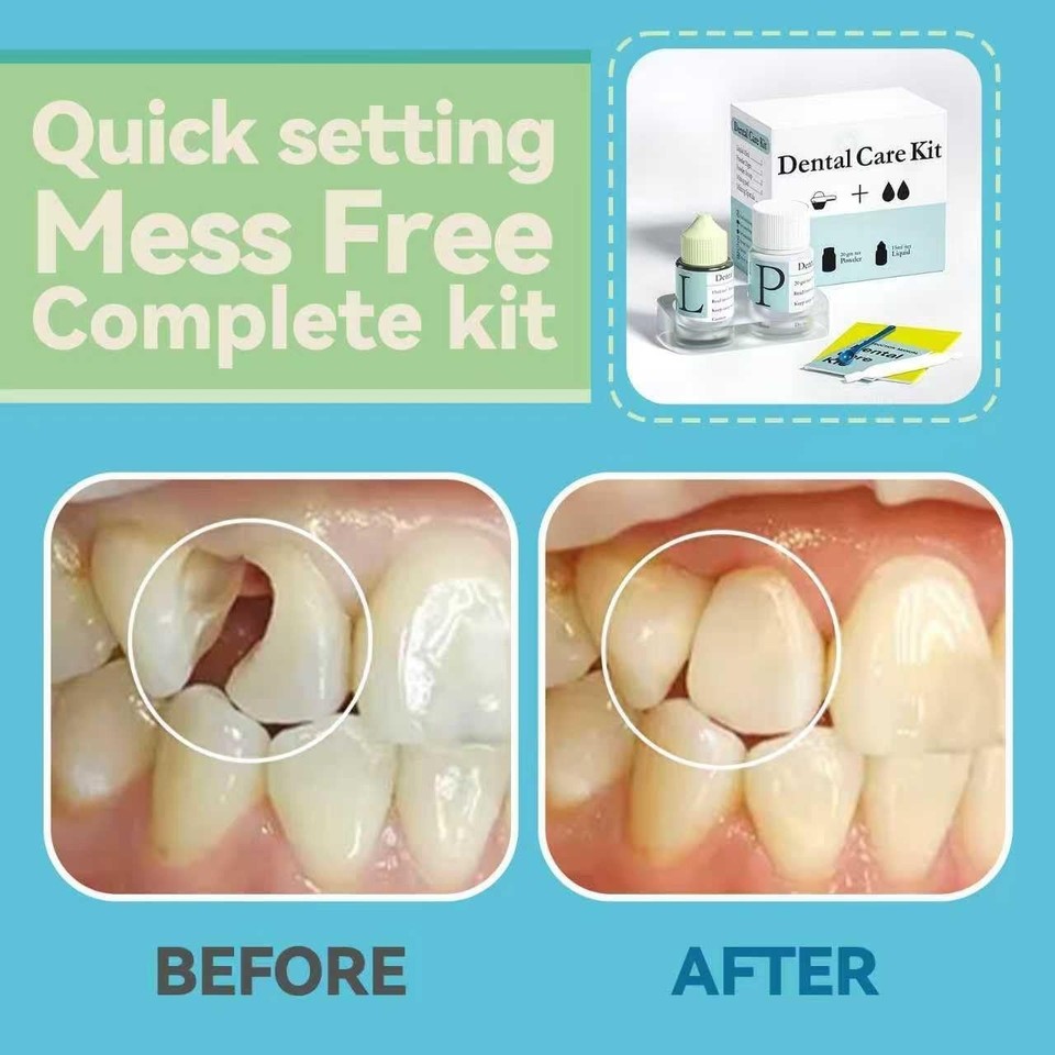 Temporary Tooth Filling Kit, Professional Tooth Replacement Care Kit ...