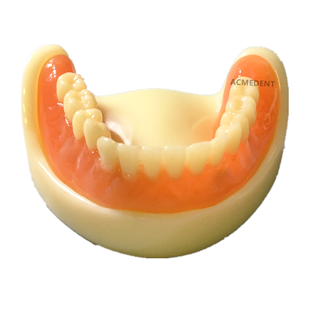 Dental Full Denture Model Overdenture Magnetic Attachment Mandibular ...