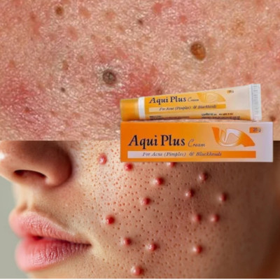 BEST cream for acne Pimples & blackheads effective cream 25gm NO SIDE ...