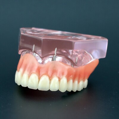 Dental Implant Overdenture Upper Superior Model Precision 4 Maxillary ...