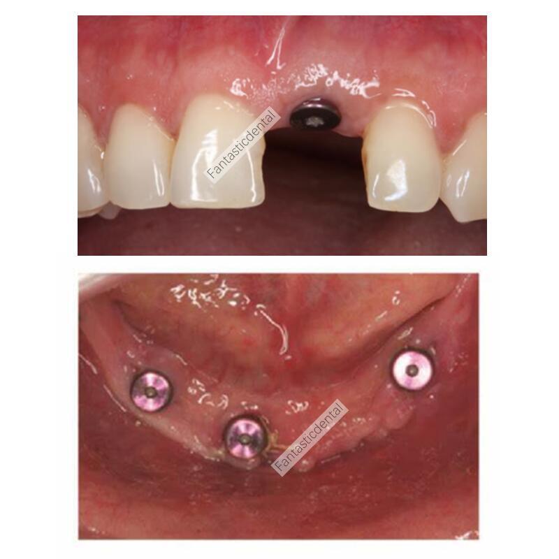 RC Dental Healing Abutment Healing Closure Regular Fit Straumann ITI ...