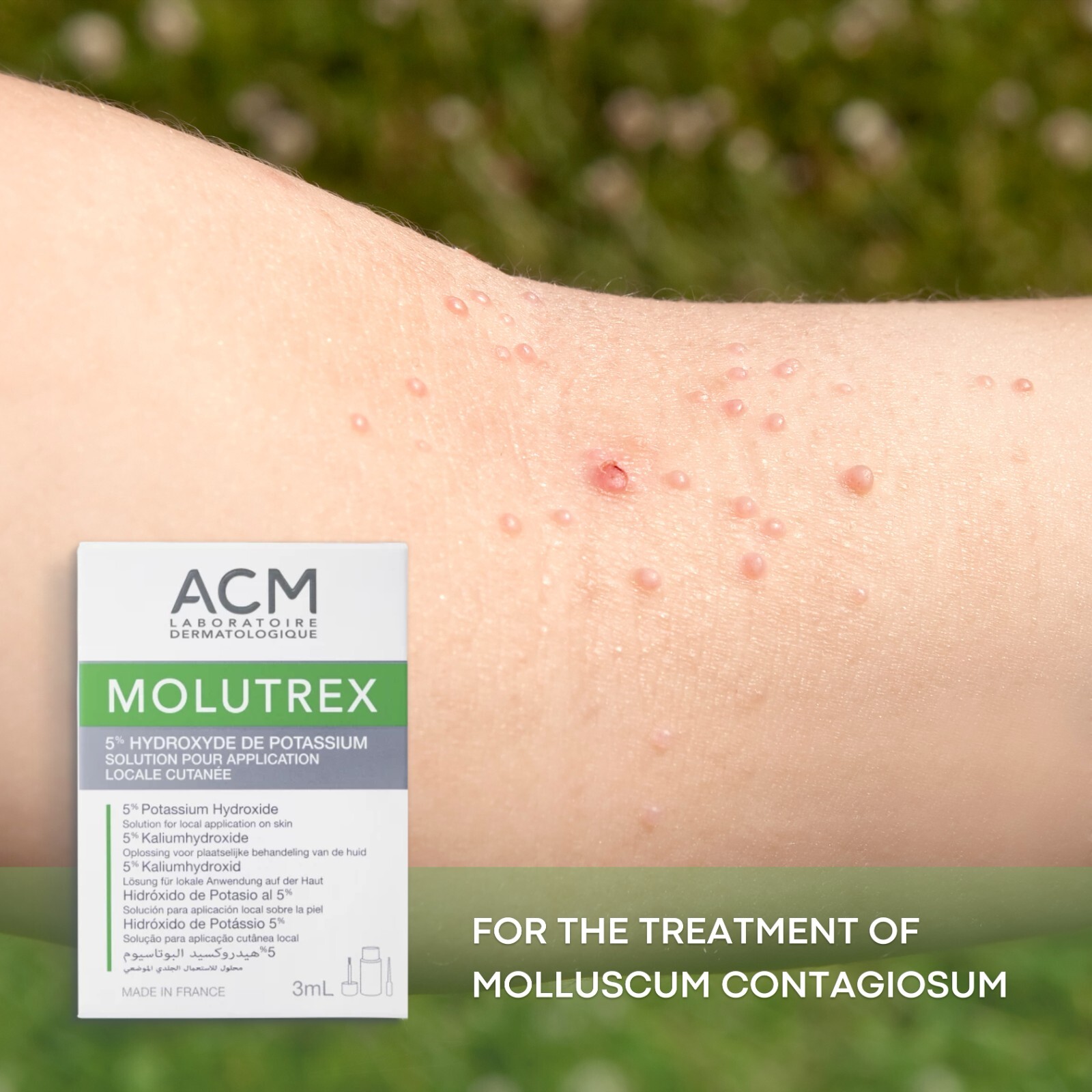 Molutrex Treatment for Mol luscum 3ml - 5% potassium hydroxide UK Stock ...