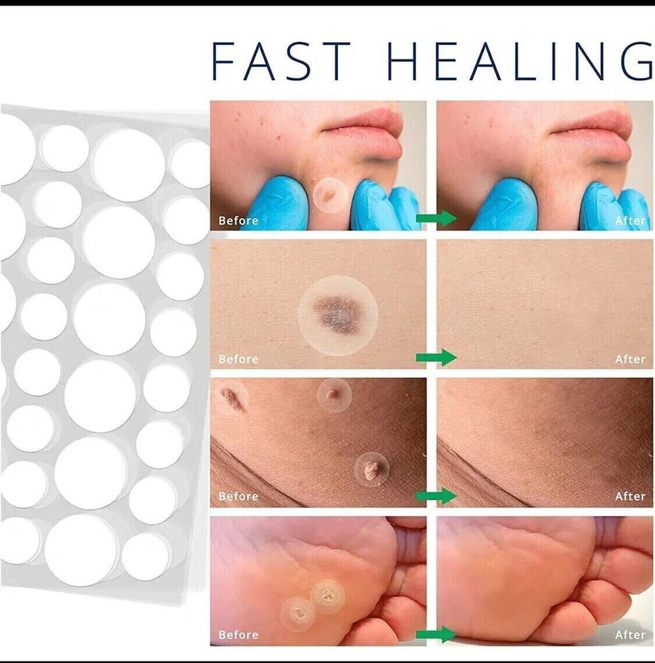 288/144pc Skin Tag Remover Patches Quick Effective Mole&Wart Pad ...