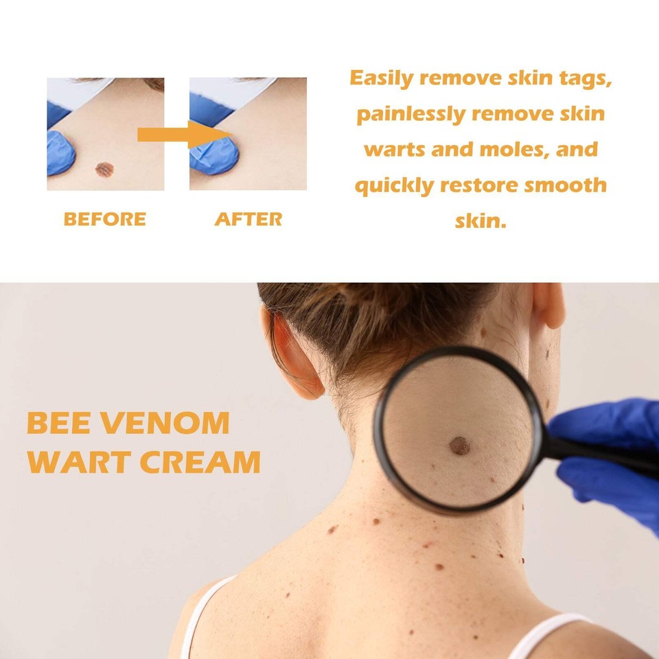 Ximonth Bee Venom Wart Cream, Repair Smooth Skin Lightening Nevus Spot ...