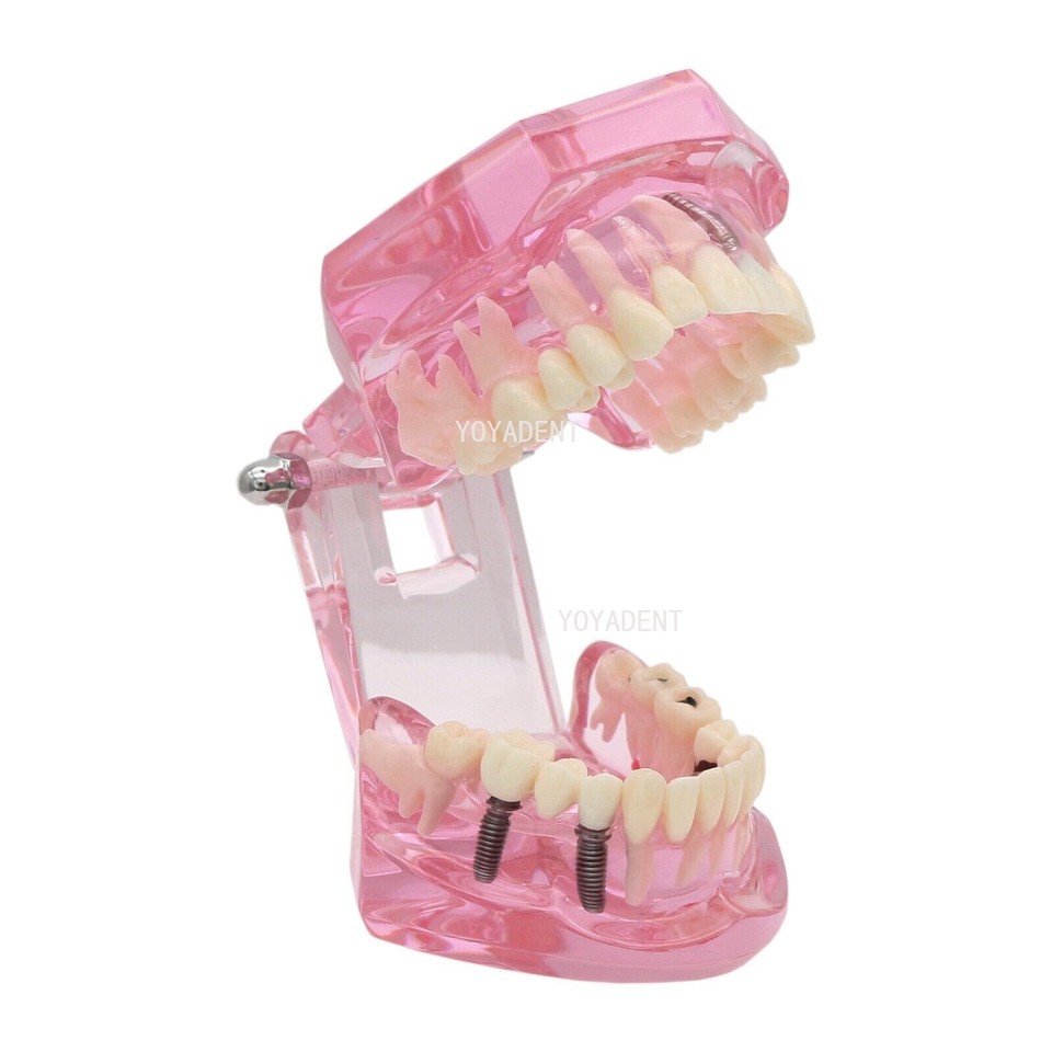 Dental teeth Model Preparation Training Teaching Ortho Implant Typodont ...