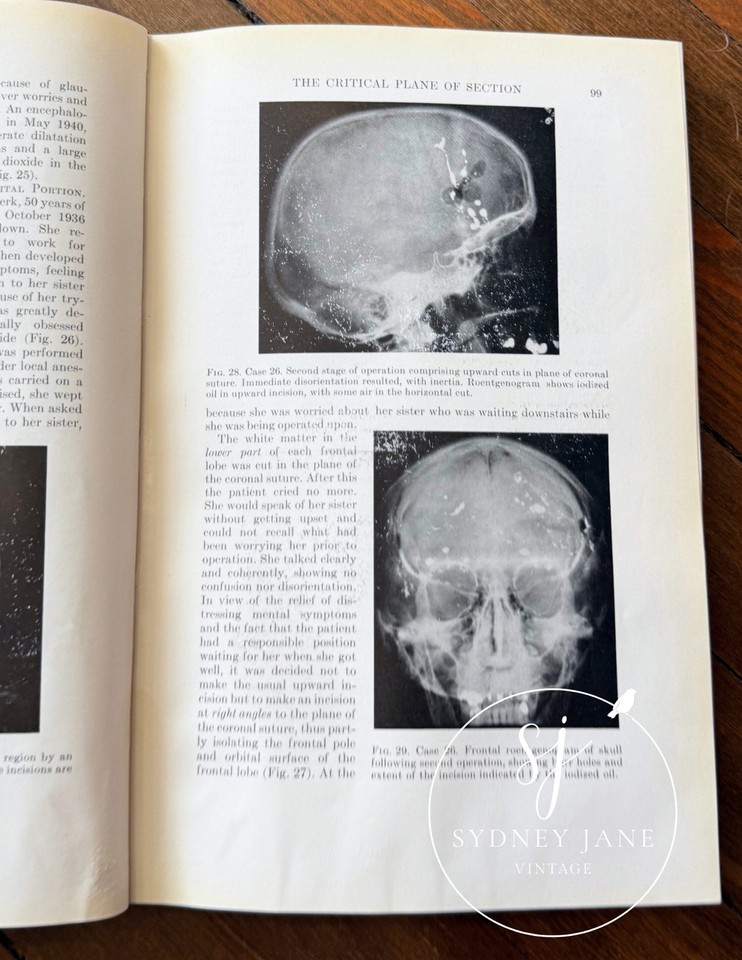PSYCHOSURGERY | Behavior Following Lobotomy | Walter Freeman | 1st Ed ...