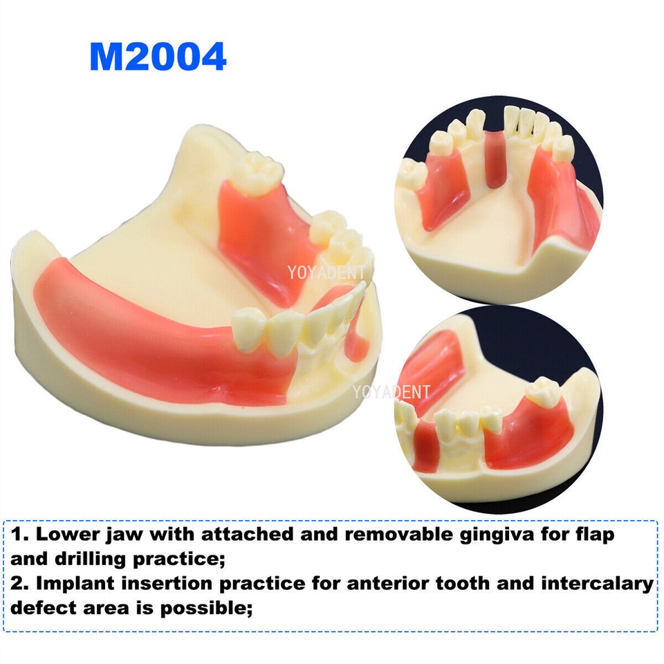 Teeth Model Dental Typodont Ortho Implant Pathological Perio Practice ...