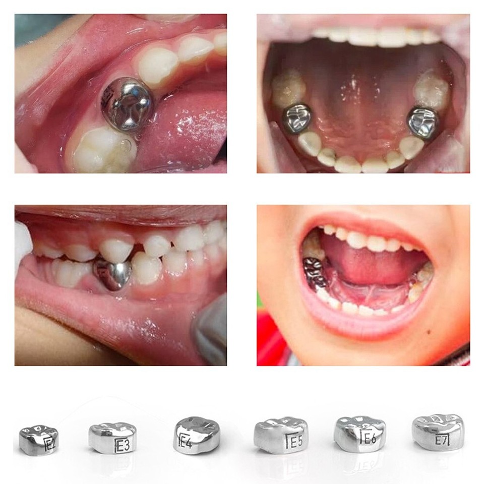 Dental Kids Primary Molar Crown Stainless Steel Pediatric Preformed ...
