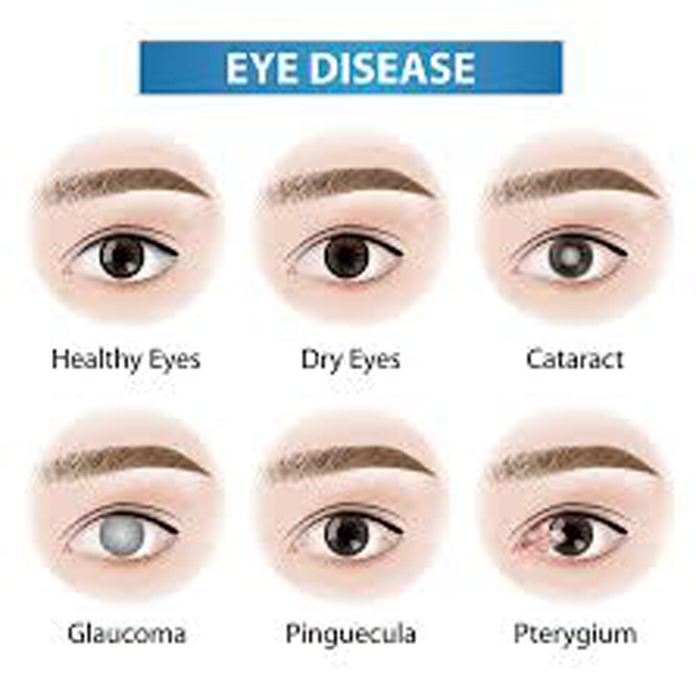 C-NAC Eye Drops Cure Cataract Carnosine NAC Glaucoma BrightC Clarity ...