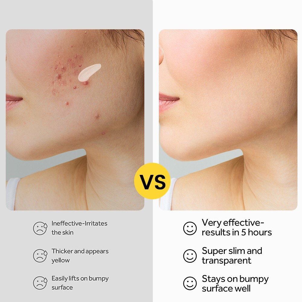 30g Acne Removal Cream Pimple Pits Pustule Deep Cleaning Face Repair ...