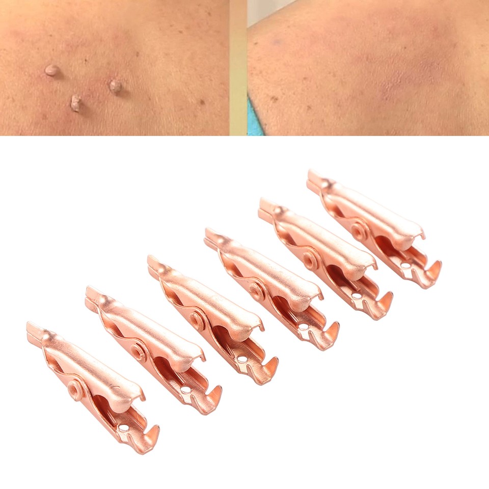 (6 Pcs)Skin Tag Remover Clips Safe Copper Smooth Skin Tag Removal Tool ...