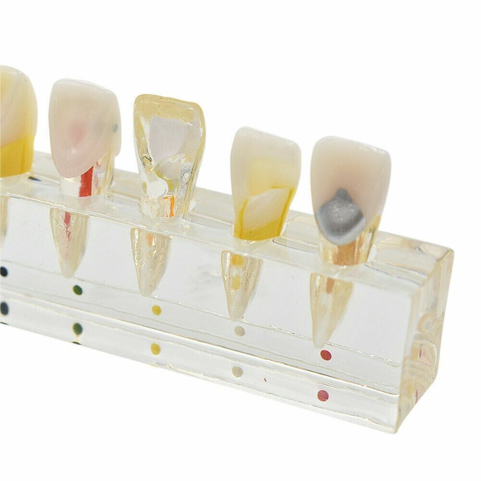 Dental Endodontic Pathology Study Model Demonstration Treatment ...