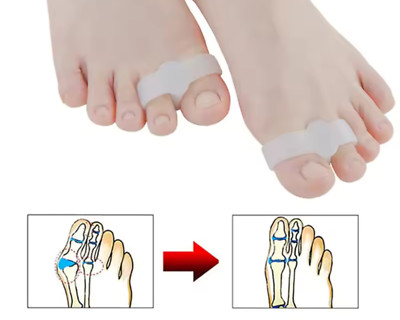 Bunion Corrector & Toe Separator | Double Loop for Overlapping Toe ...