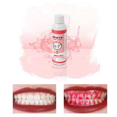 Plaque Disclosing Agent Oral Tartar Test Examination Dental Indicator ...