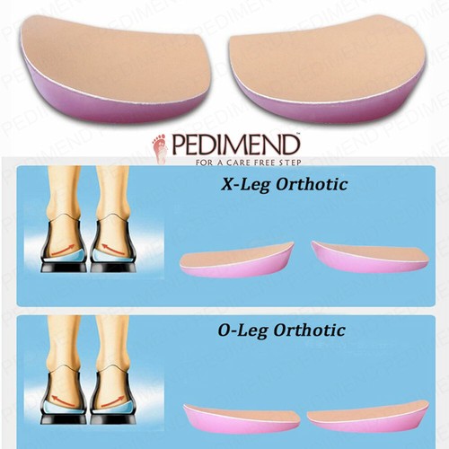 Knock-Knees Bow Legs Correction O/X Type Legs Insoles by PEDIMEND ...