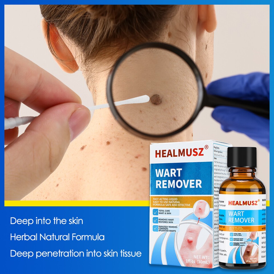 Wart Remover Liquid Skin Tag Mole Remover Eliminate Feet Corn Wart ...