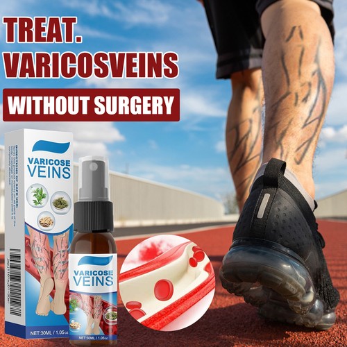 30ml Varicose Vein Spray Herbal Varicose Veins Remedy Spray for Legs ...