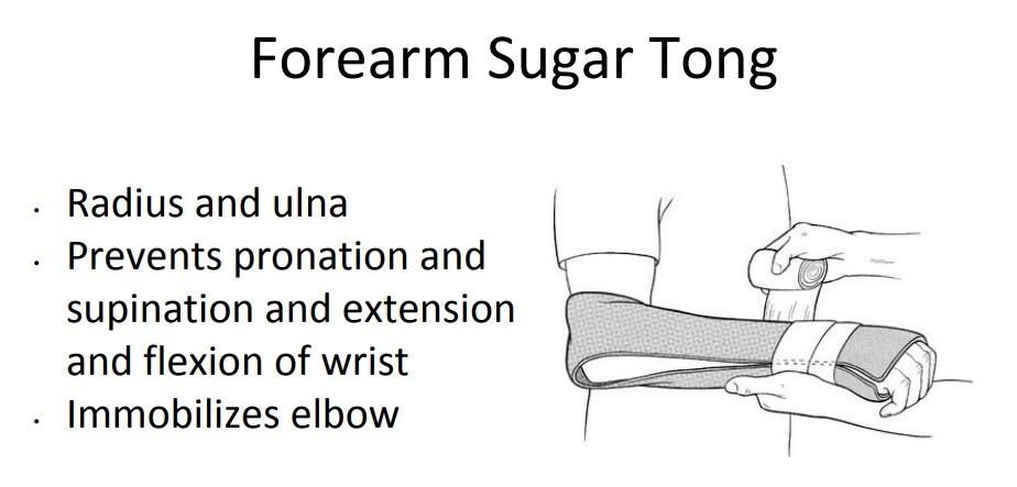 Reverse Sugar Tong Splint