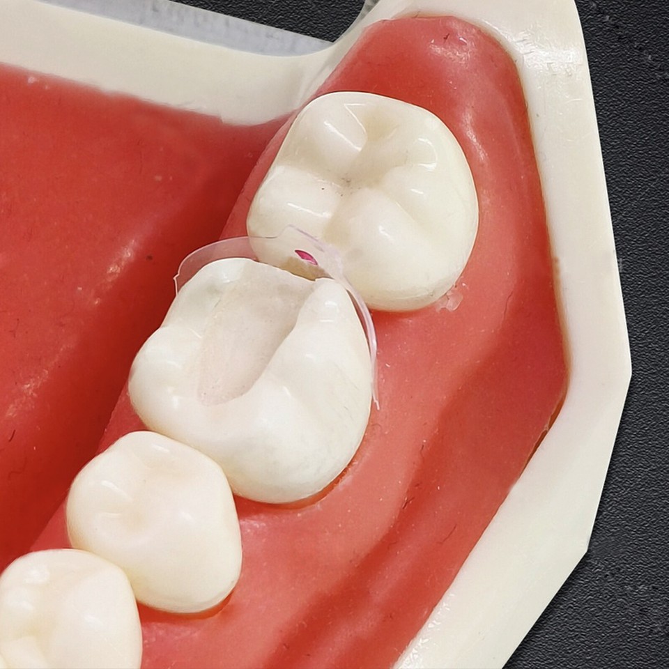 Clear Matrix Band Transparent Bow Matrices Dental Anterior Front Teeth ...