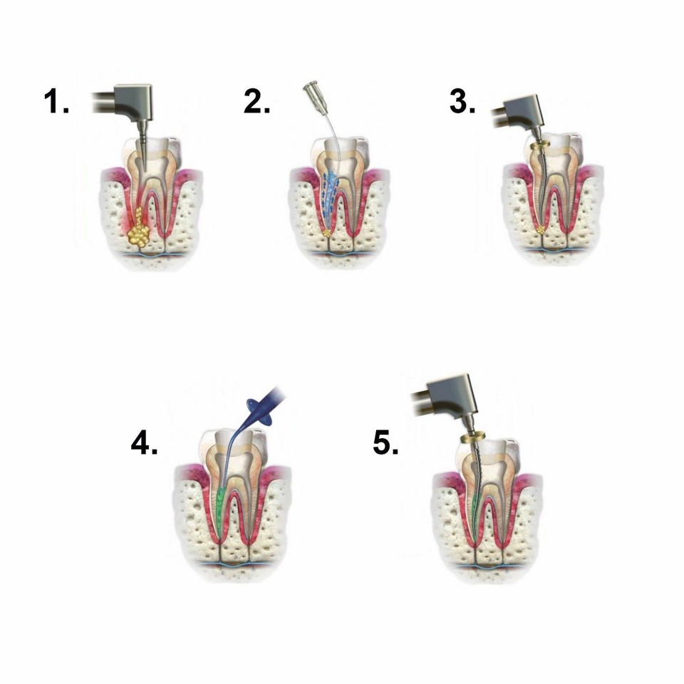 DSI ApexCream Dental EDTA 18% Endodontic Cream Root Canal RC Prep 20g Jar | eBay