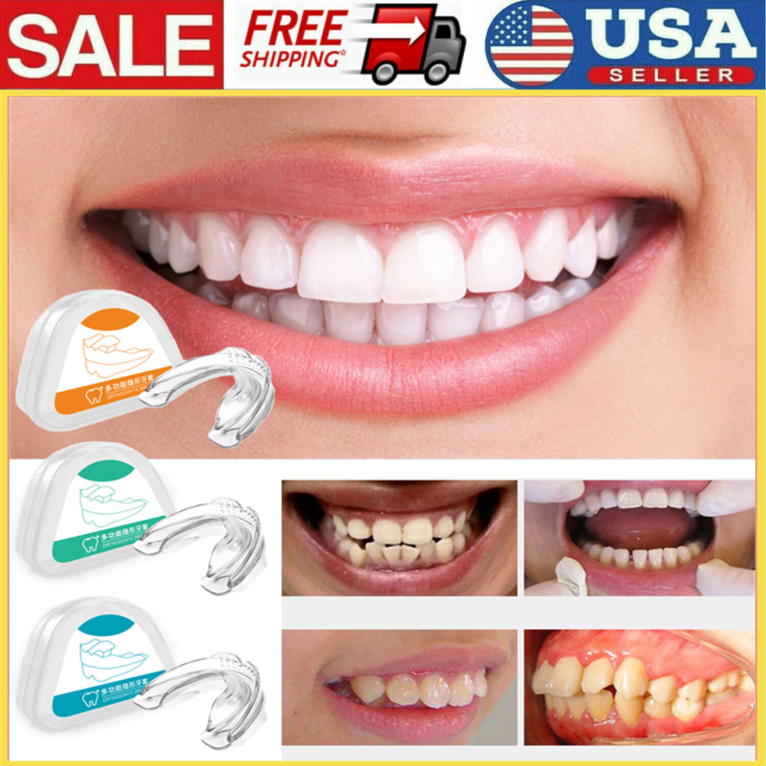 Retainer Designs Like Brace