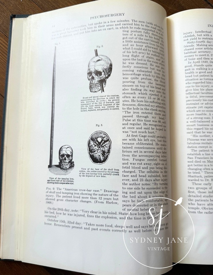PSYCHOSURGERY | Behavior Following Lobotomy | Walter Freeman | 1st Ed ...
